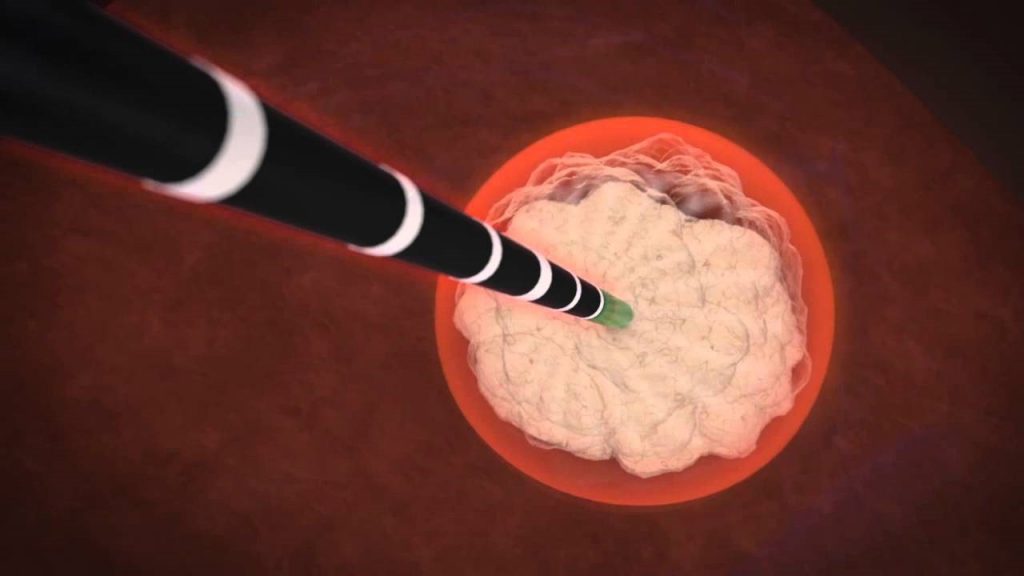 Microwave Ablation - MPLS Vascular
